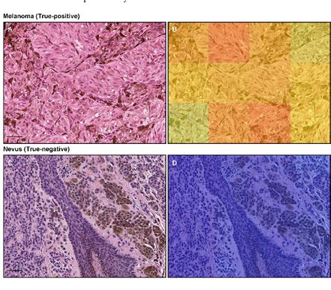 Figure 4 From Deep Learning Approach To Classify Cutaneous Melanoma In A Whole Slide Image
