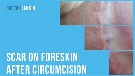 😕 Scar On Foreskin After Circumcision Youtube