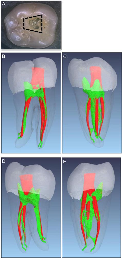 Cec In A Mandibular First Molar A The Occlusal View For Comparison Download Scientific