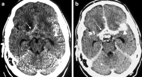 Axial Ct Demonstrating Inhomogeneous Hyperdense Basal Cisterns A