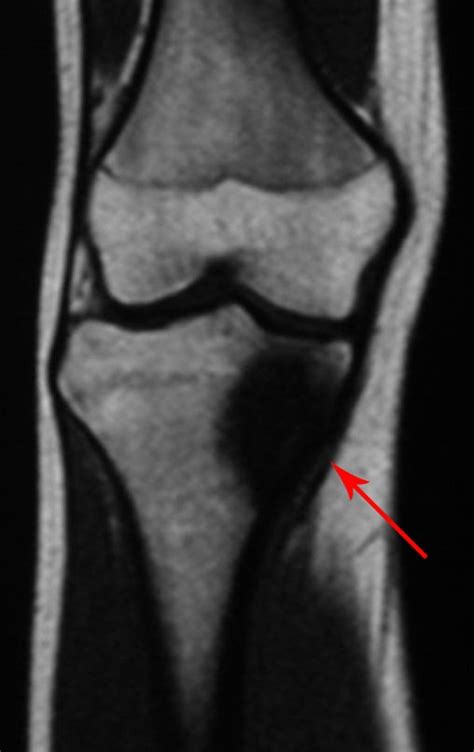 Osteosarcoma De La Tibia Prótesis Parcial Rotatoria Oncocirugia