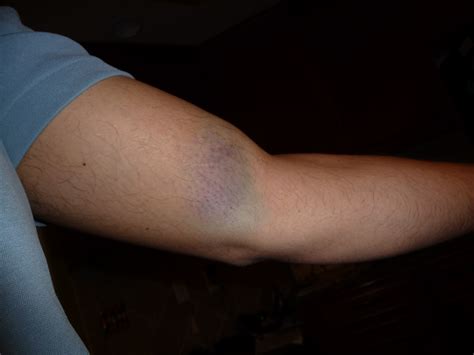 Biceps Muscle Injuries