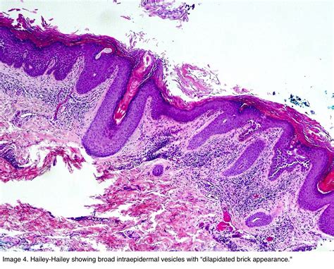 Pathology Outlines Hailey Hailey Disease