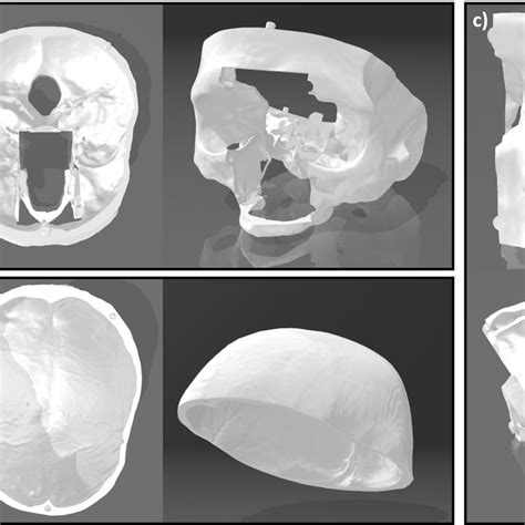 Computational Model Of The Skull Segmented From The Cbct Image The