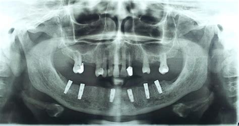 Maxillary Cast Partial Denture And Mandibular Implant Supported Ceramometal Prosthesis With A