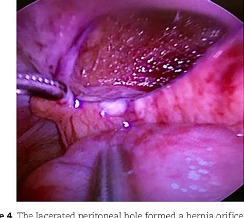 Figure 4 From Preperitoneal Herniation After Transabdominal Preperitoneal Patch Plasty A Case