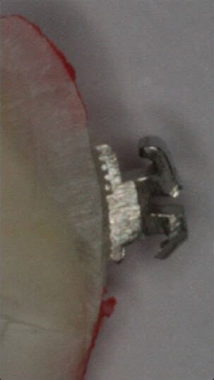 Evaluation Of Microleakage For The Brackets At Both The Download Scientific Diagram