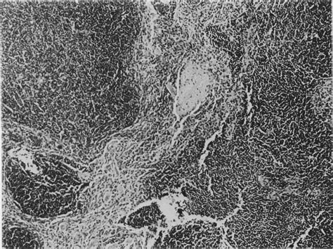 Spleen 24 H After Injection Of C Parvum Thrombus In Splenic