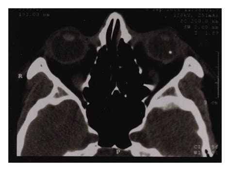 Ct Scan Depicting An Intraocular Foreign Body In The Left Eye