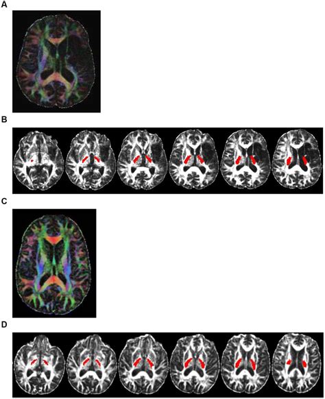 color coded diffusion tensor imaging dti images and the plic