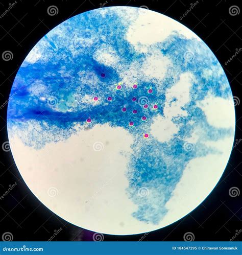 Cryptococcus Neoformans In Lung Tissue Warthin Starry Silver Stain