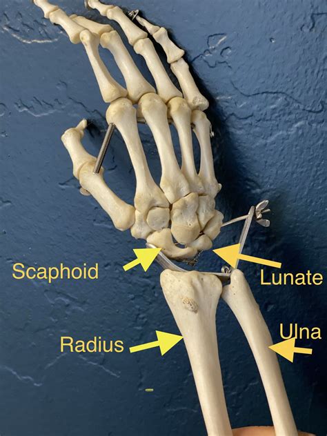 Ulnar Styloid Pain