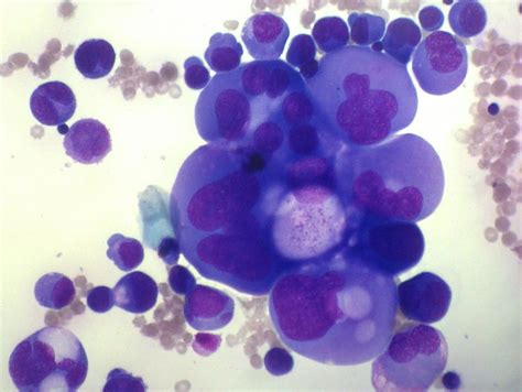 The Cell Hunter Society Case No Ngc2097 11 Pleural Fluid