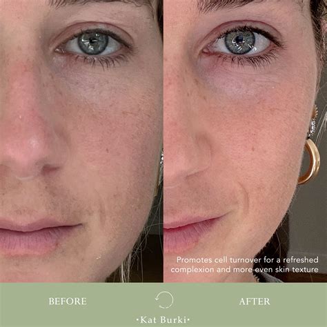 Retin A Eyes Before And After Vitamin C Fix Eye Cream 10 Retin A Eyes Before And After Vitamin C Fix Eye Cream 10