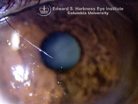 Trichiasis Vagelos College Of Physicians And Surgeons