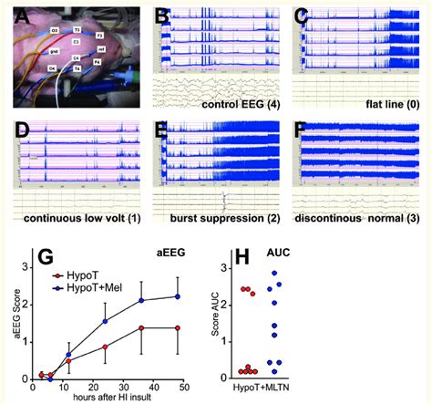 Effect Of Melatonin Cotreatment On Amplitude Integrated Eeg A