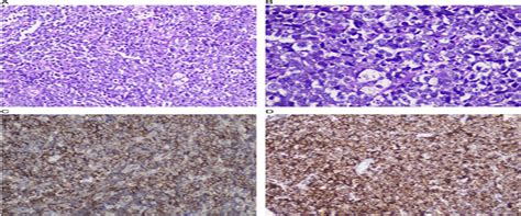 Plasmablastic Lymphoma In A Human Immunodeficiency Virus Pos Journal Of Pediatric