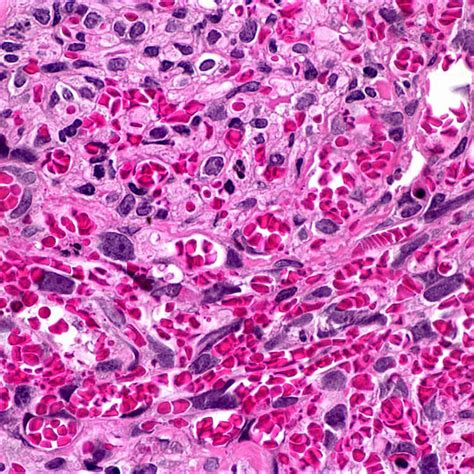 Angiosarcoma Basicmedical Key