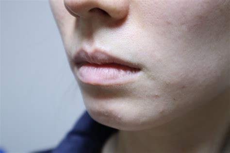 부산 입술필러 입꼬리보톡스 한달 후기 네이버 블로그