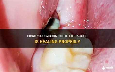 Signs Your Wisdom Tooth Extraction Is Healing Properly Medshun