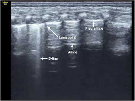 Video 1 Neonatal Normal Lus Positive Lung Sliding Under Real Time Us