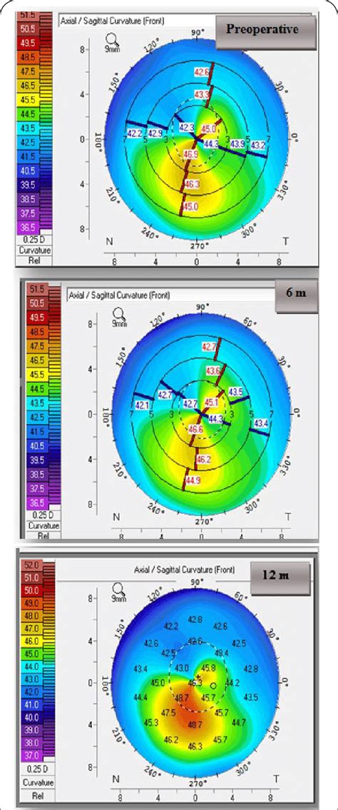 Pentacam Anterior Curvature Map Of Female Kc Patient 22 Years Old