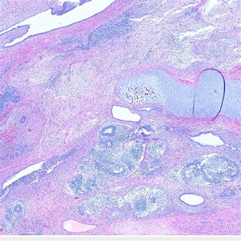 Histologic Imaging Showing Cartilage Glandular And Immature Neural Tissue Download
