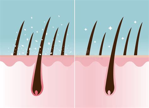 Comparison Of Dandruff In Hair And Healthy Hair On Scalp Layer Vector