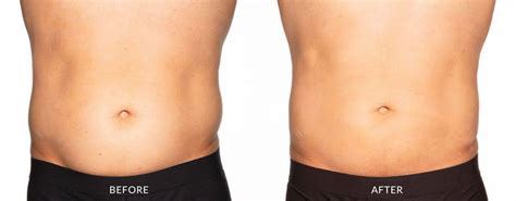 Coolsculpting Stomach El Paso Tx Abdomen Coolsculpting