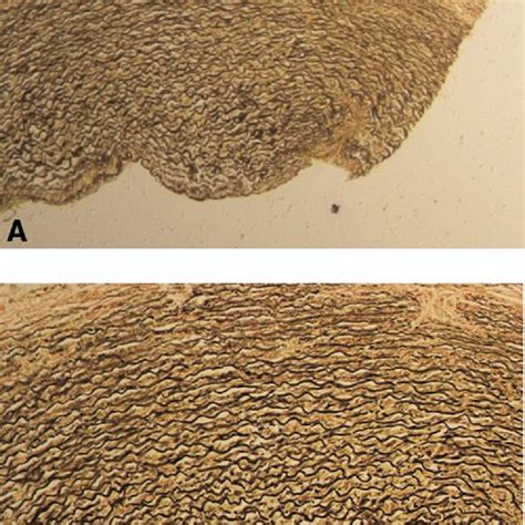 Figure E1 A And B Photomicrographs Of The Ascending Aortic Biopsy