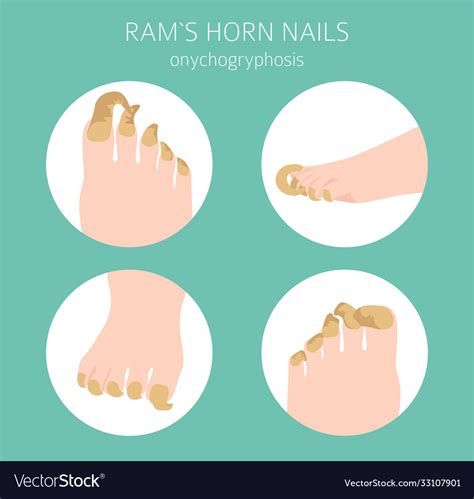 Onychogryphosis Removal