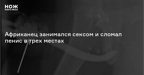 Африканец занимался сексом и сломал пенис в трех местах — Нож