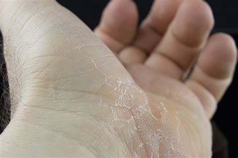 ¿cómo Puedo Eliminar Los Hongos En Las Manos Los Remedios Caseros