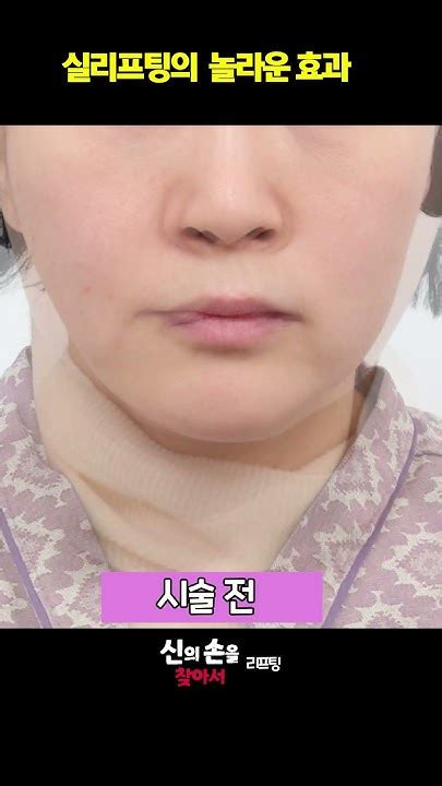 실리프팅의 놀라운 효과 실리프팅실리프팅효과박수연원장 Liftingps Youtube
