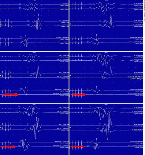 Table 1 From Multimodal Intraoperative Spinal Cord Monitoring During