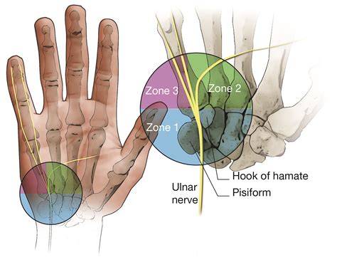 Ulnar Tunnel Syndrome Of The Wrist Orthoinfo Aaos