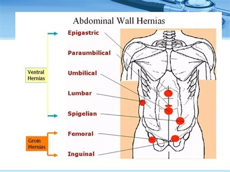 Ventral Hernia By Dr Teo Ppt