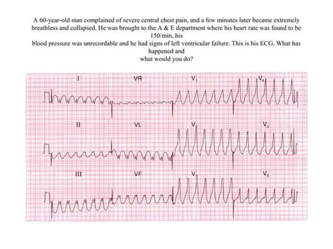 Ecg Evaluation Ppt