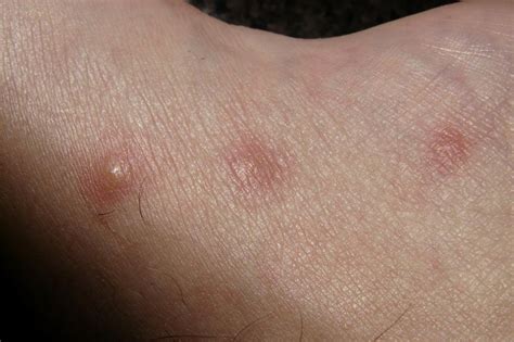 Alternative Treatment For Allergic Reaction To Substance Discovered UPI Com