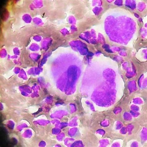 Case Of Itp Showing Increased Number Of Megakaryocytes 1000x Download Scientific Diagram