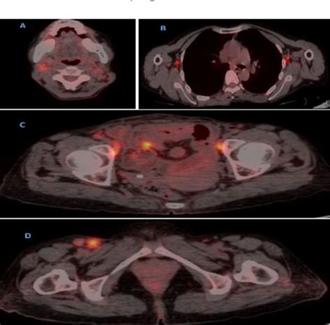 Figure 1 From Ileal Intussusception Due To Primary Intestinal Melanoma With Generalized Lymph