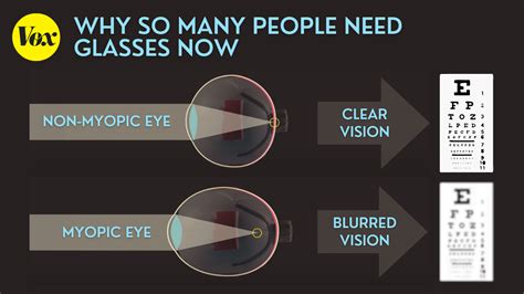 Myopia Management — Cv Optometry