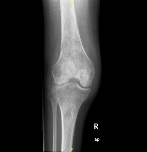 Right Knee X Ray Anterior Posterior View Of The Right Knee Showing