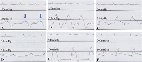 Intracardiac Pressure Waveform With A Swan Ganz Catheter A The Right