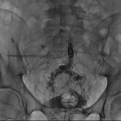 Sigmoidoscopy Showing Large Rectal Varices Before The Balloonoccluded