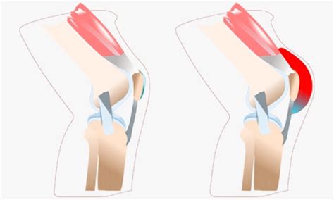 Prepatellar Bursit Nedir Nedenleri Belirtileri Ve Tedavisi