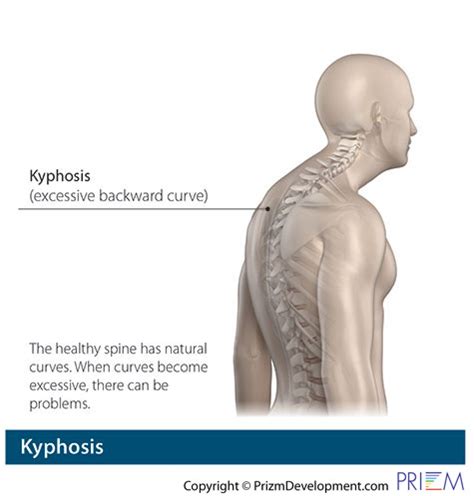 Kyphosis Types Symptoms Causes Diagnosis Pictures What Is Kyphosis