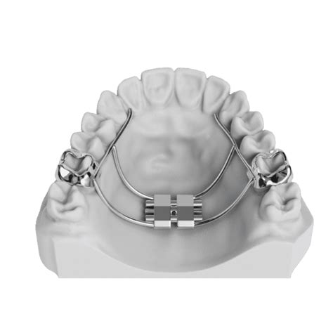 Palatal Expander Digital Designs Dental Lab