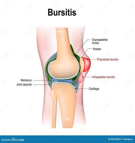 Bursitis Is The Inflammation Of Bursae Stock Vector Illustration Of