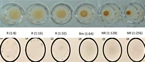 Development Of A Novel Magnetic Particle Based Agglutination Immunoassay For Anticardiolipin